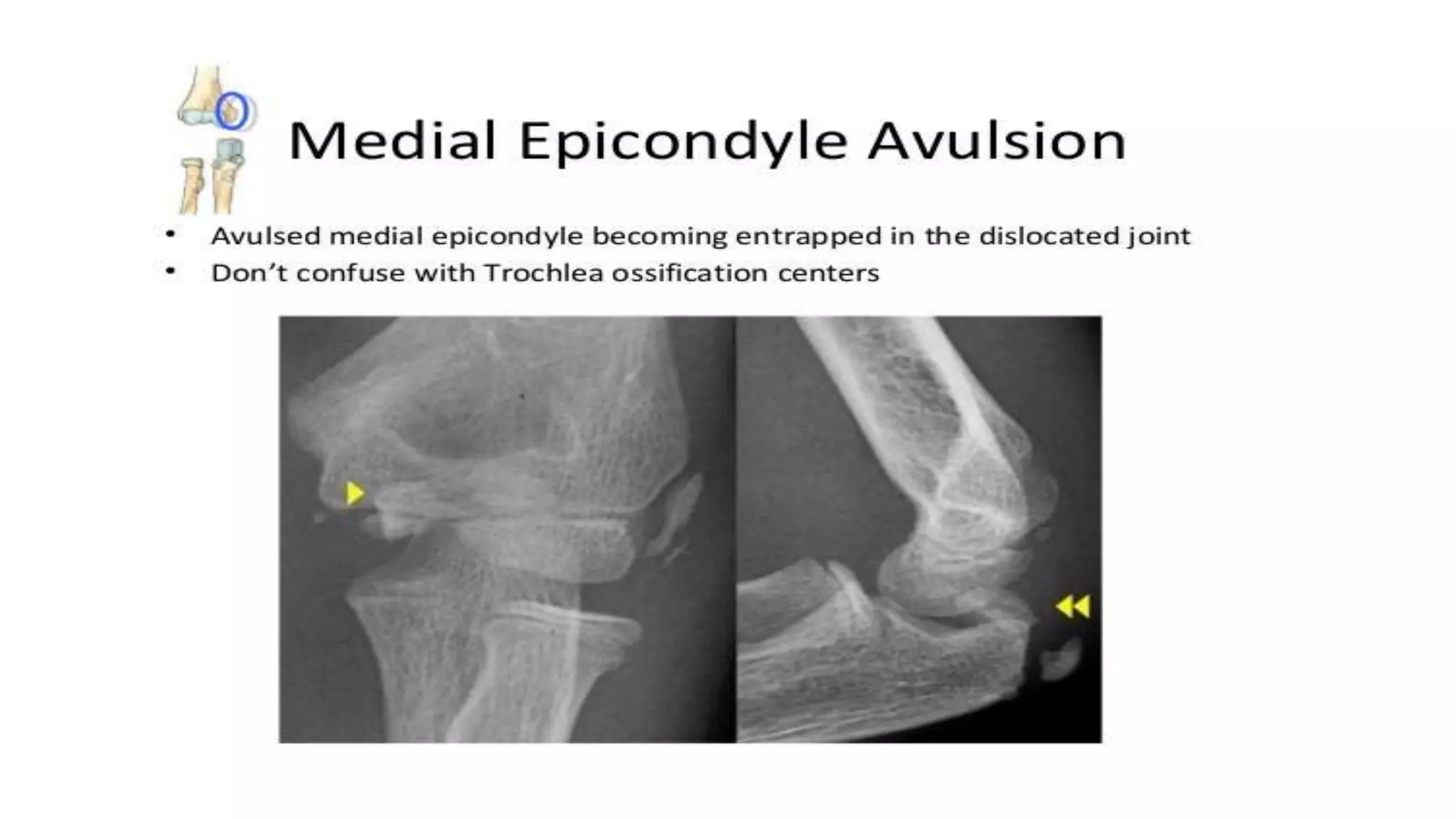 MEDIAL EPICONDYLE FRACTURE BY DR. VASU SRIVASTAVA | PPTX