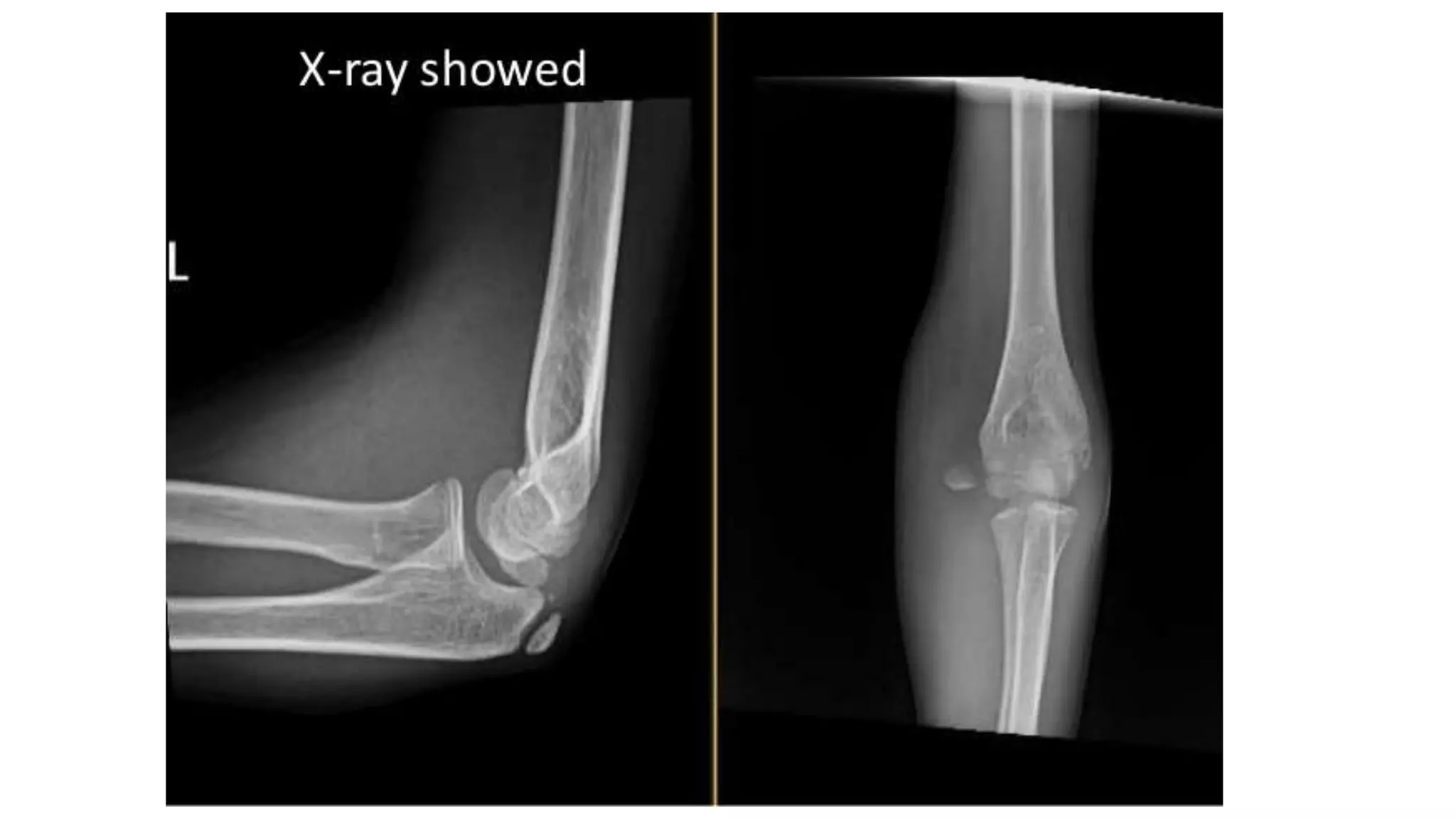 MEDIAL EPICONDYLE FRACTURE BY DR. VASU SRIVASTAVA | PPTX