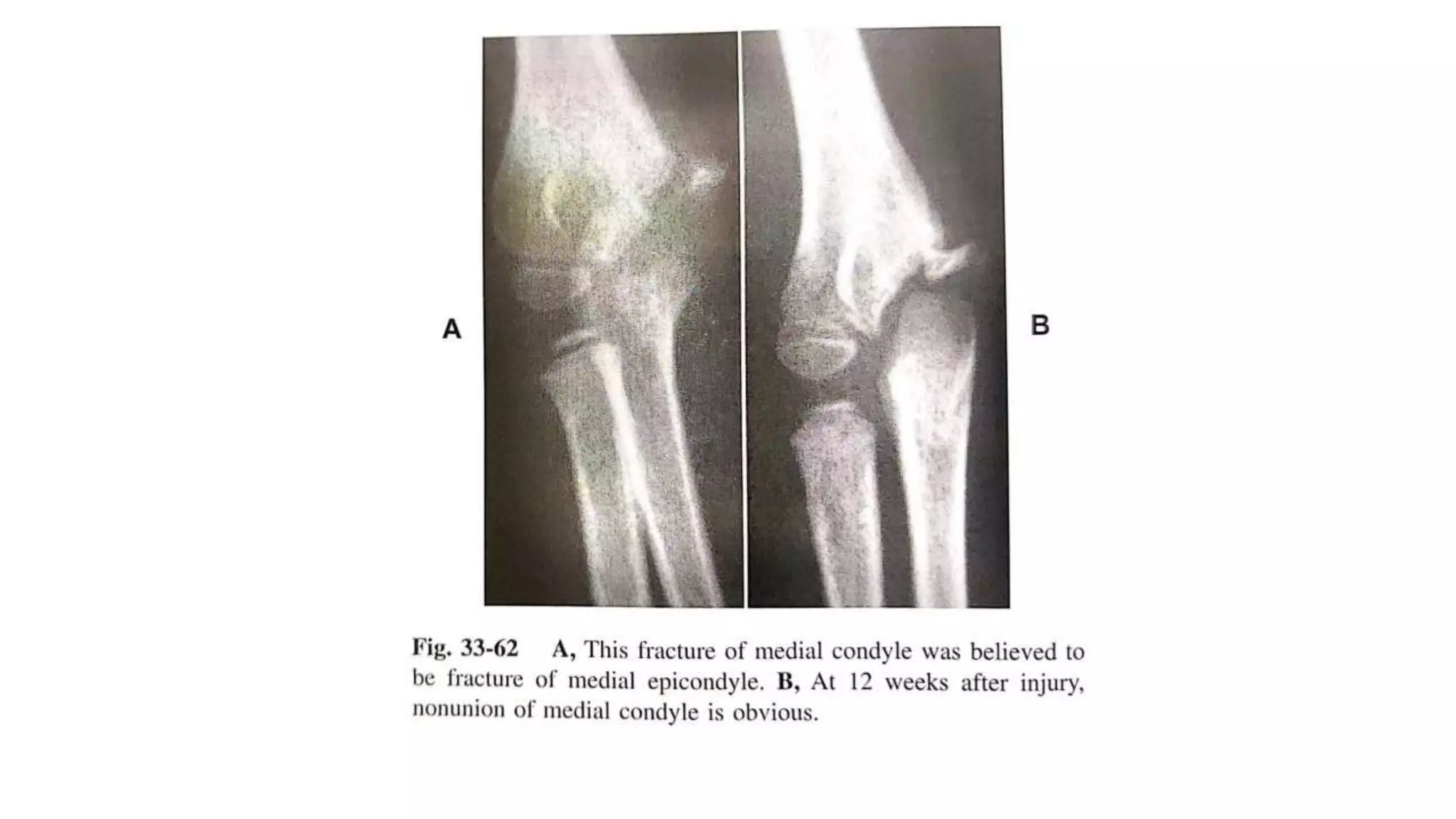 MEDIAL EPICONDYLE FRACTURE BY DR. VASU SRIVASTAVA | PPTX