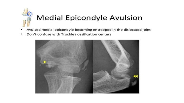MEDIAL EPICONDYLE FRACTURE BY DR. VASU SRIVASTAVA | PPTX