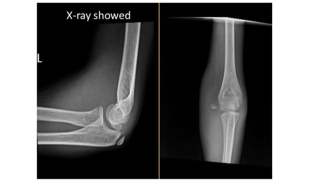 MEDIAL EPICONDYLE FRACTURE BY DR. VASU SRIVASTAVA | PPT
