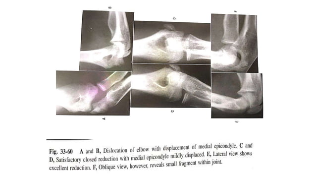 MEDIAL EPICONDYLE FRACTURE BY DR. VASU SRIVASTAVA | PPT