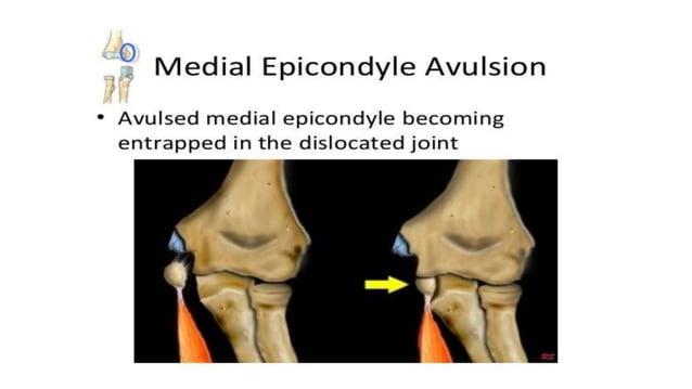 MEDIAL EPICONDYLE FRACTURE BY DR. VASU SRIVASTAVA | PPTX