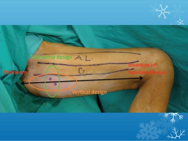 Medial thigh flap journal club