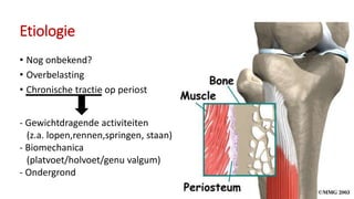 Medial tibial stress syndrome (MTSS) | PPTX
