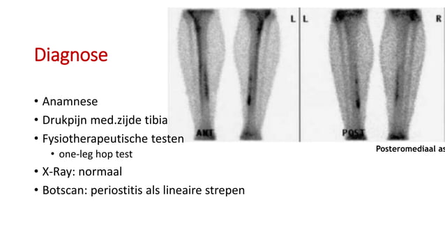 Medial tibial stress syndrome (MTSS) | PPTX