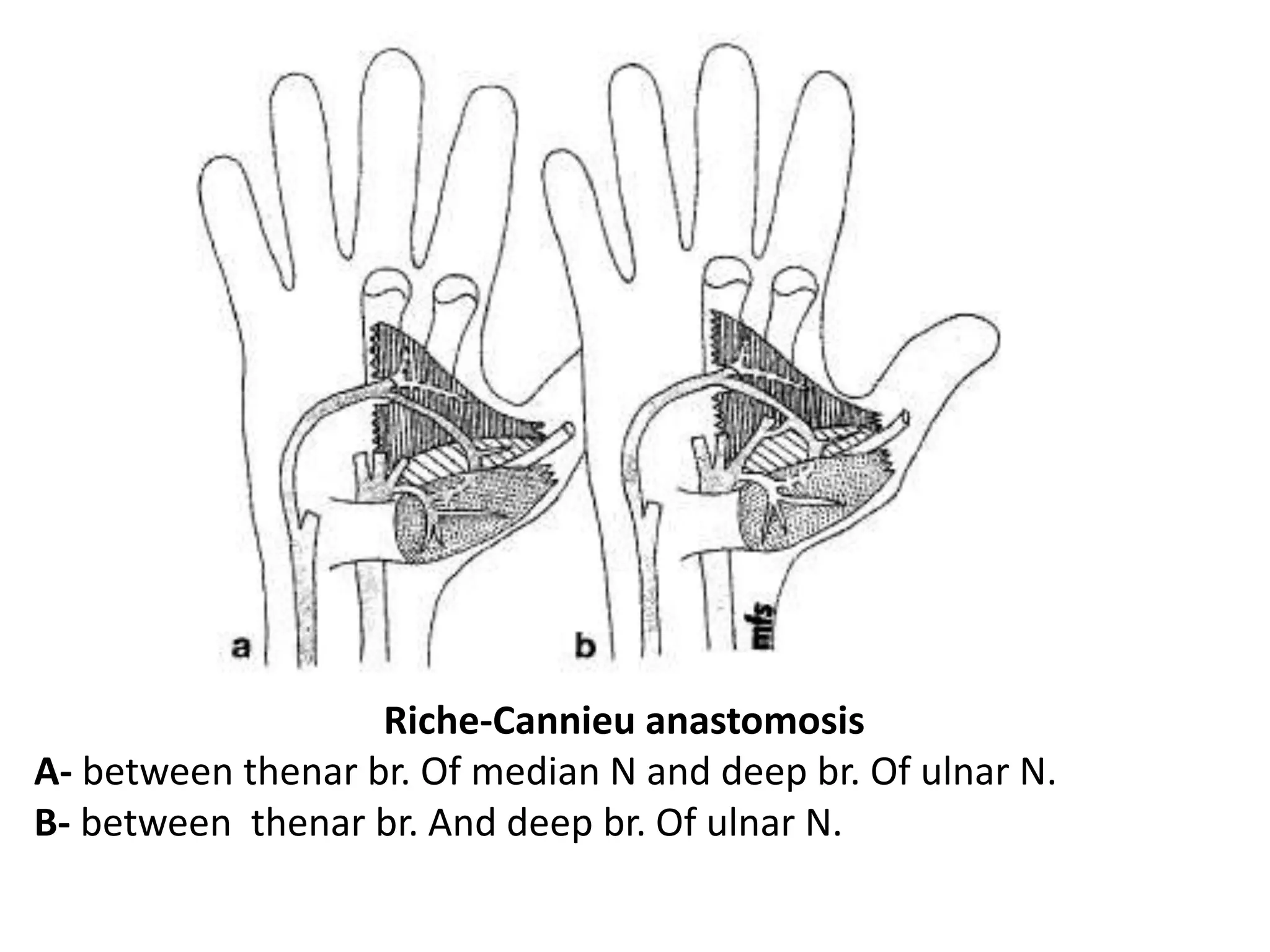 Median median anatomy carpal tunnel syndrome.pptx