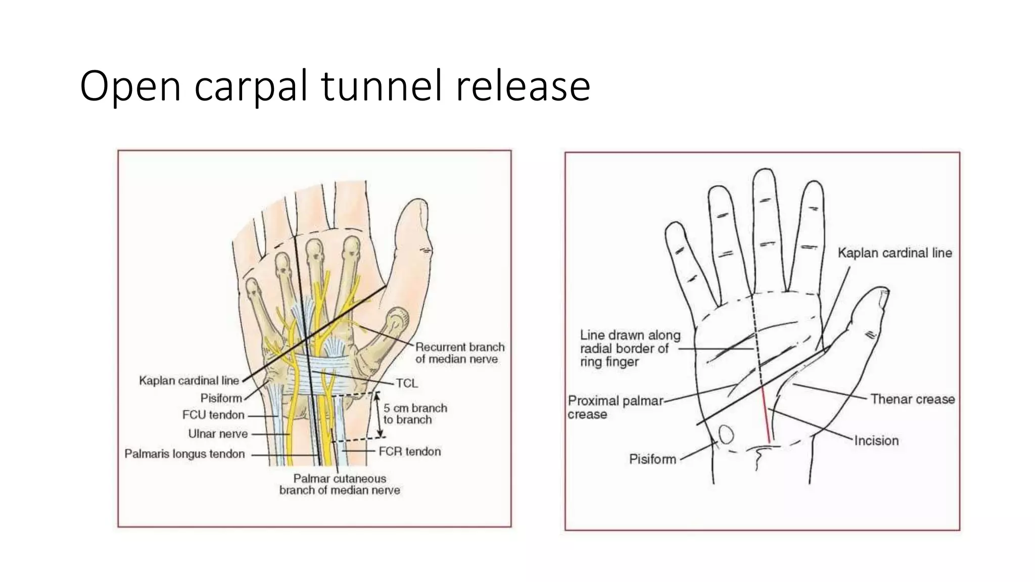 Median nerve injury | PPTX