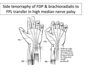 Median nerve injuries | PPTX