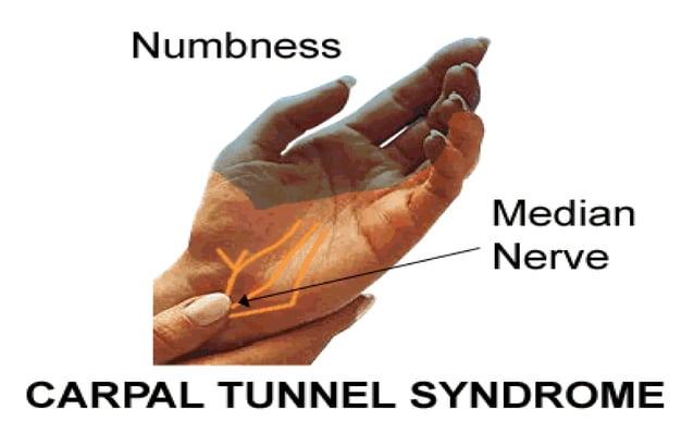 Median nerve injuries