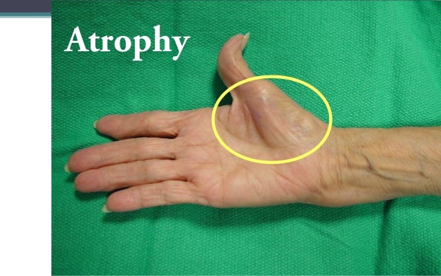 Median nerve injuries