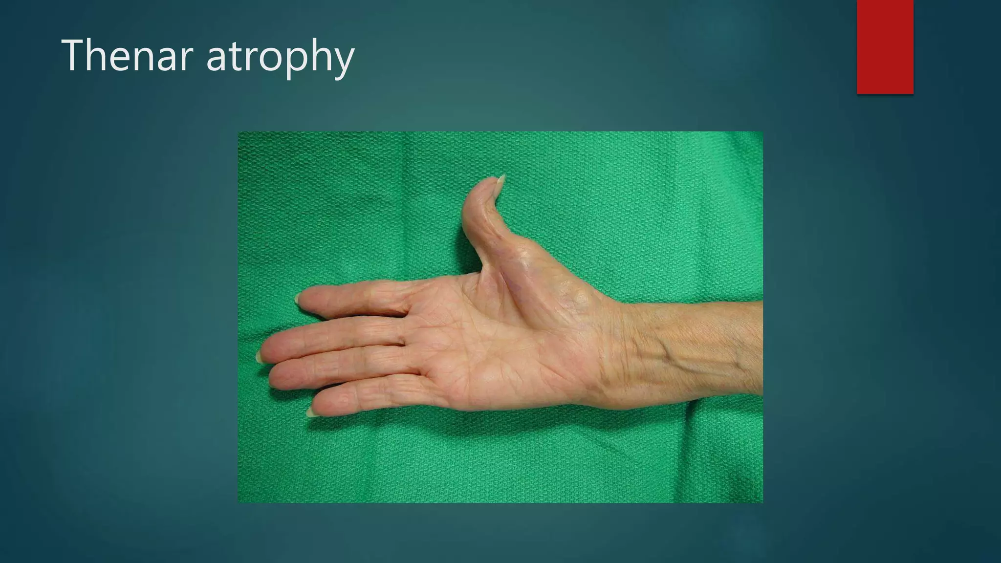 Median nerve injuries | PPTX