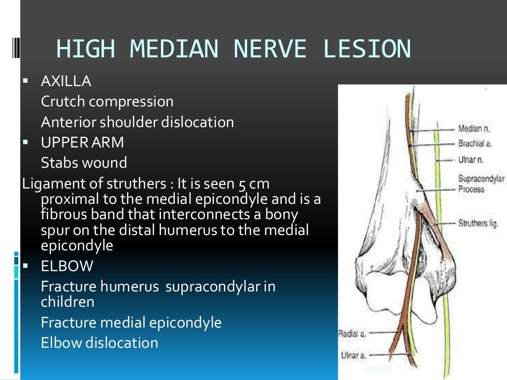 Median nerve injury