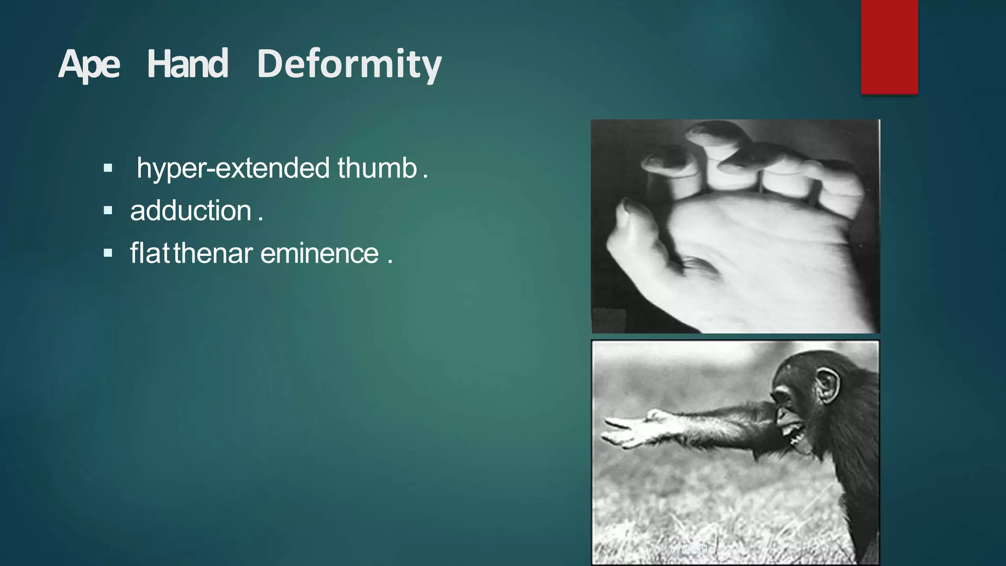 Median nerve palsy | PPTX