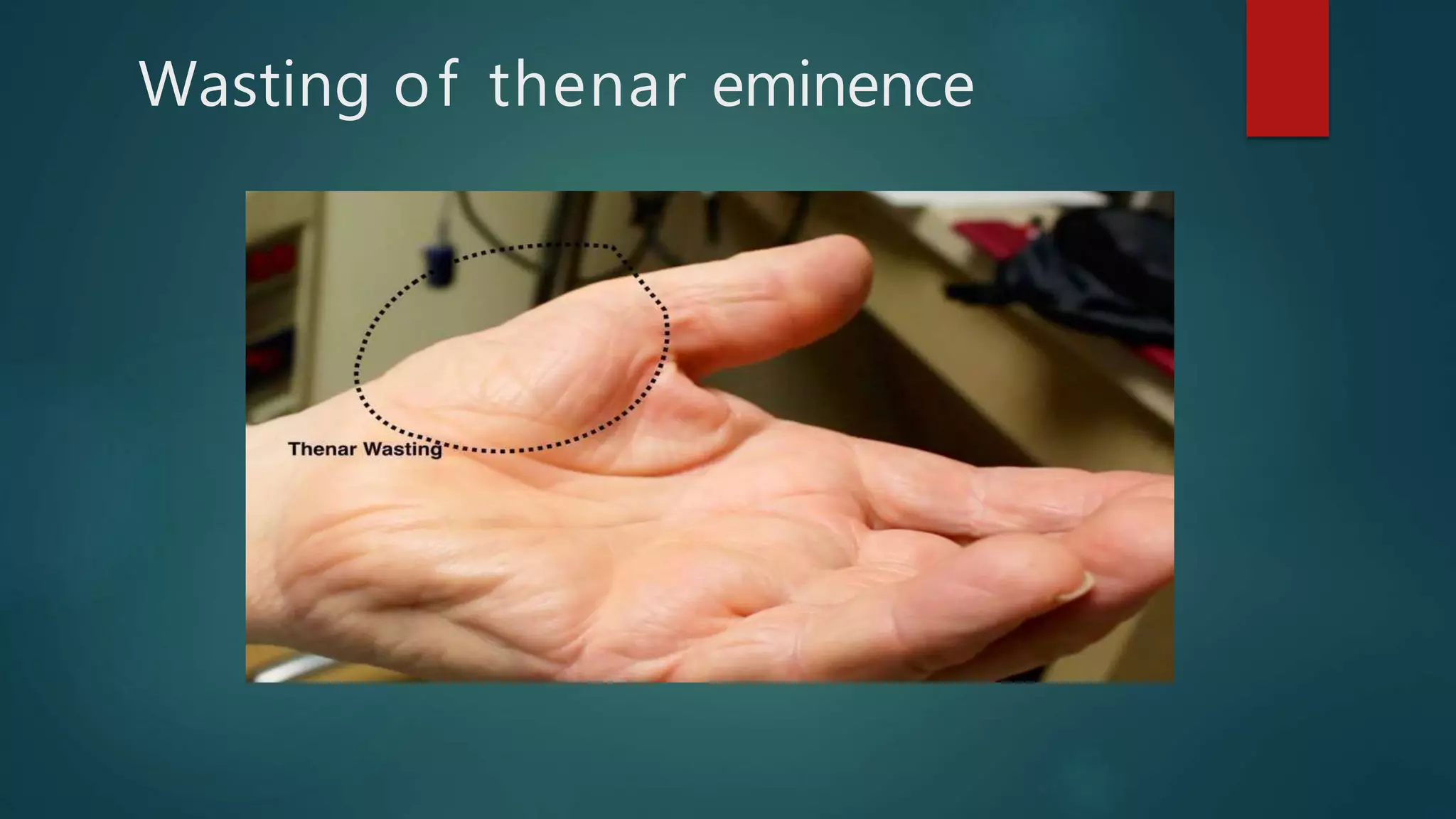 Median nerve palsy | PPTX