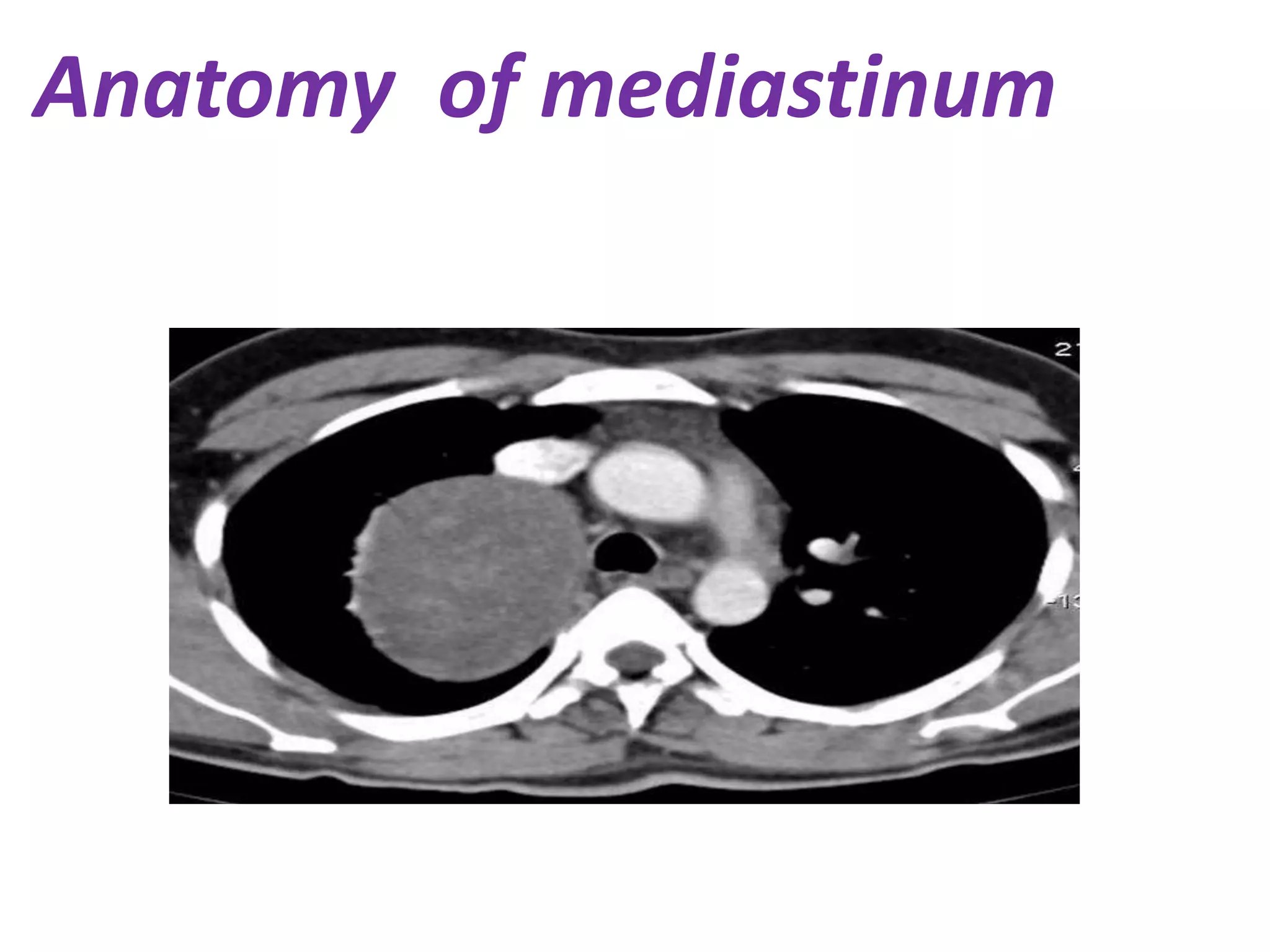 Mediastinal anatomy ,classification of mediastinal masses ans its ...