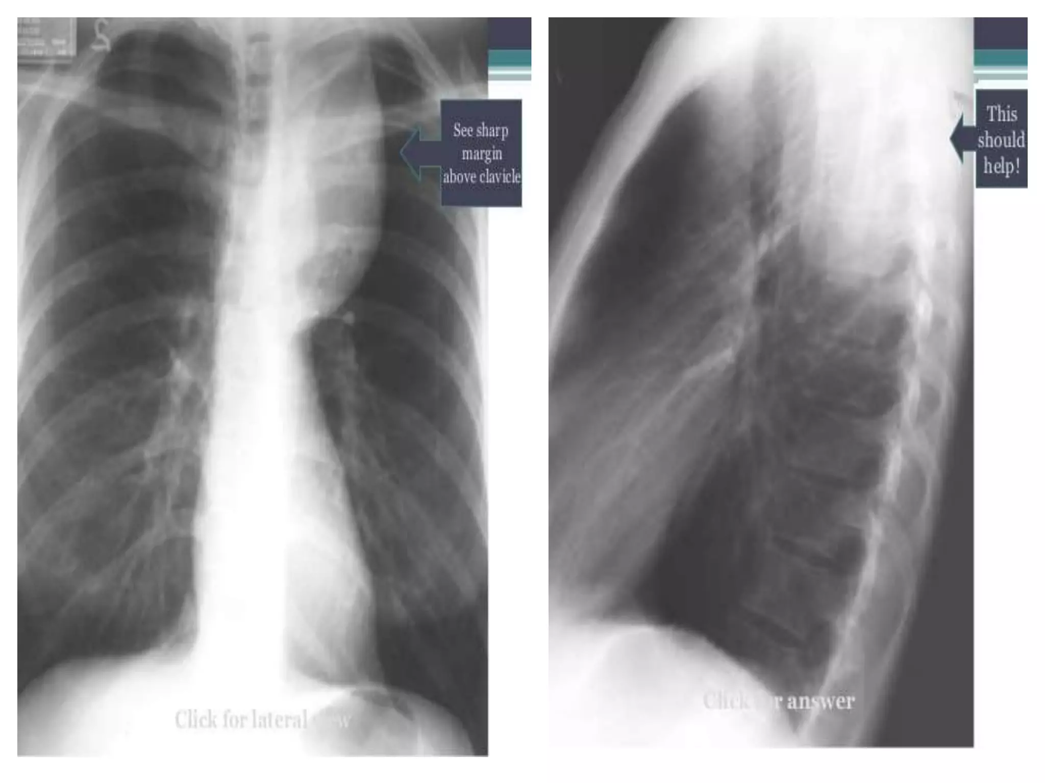 Mediastinal anatomy ,classification of mediastinal masses ans its ...