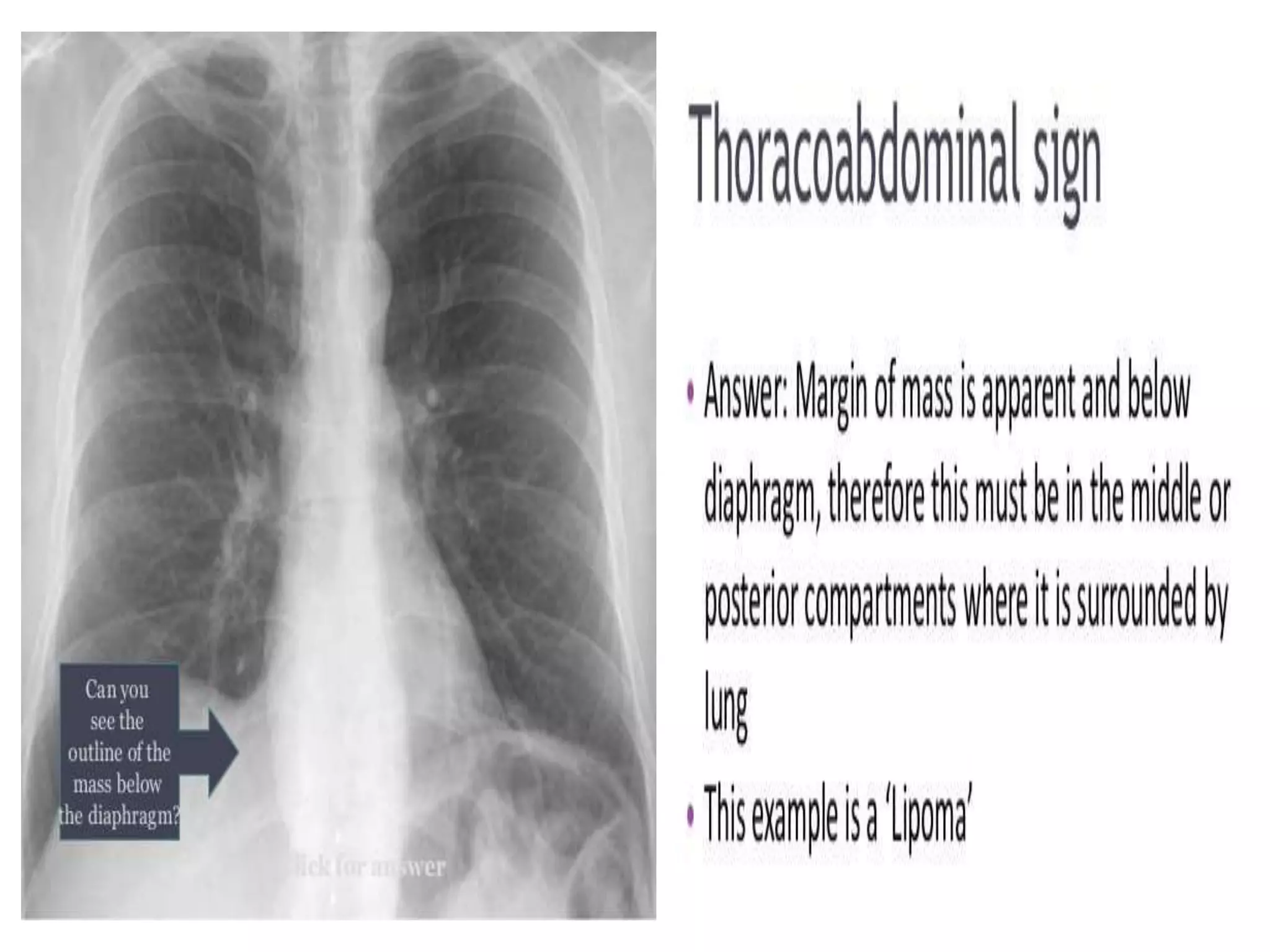 Mediastinal anatomy ,classification of mediastinal masses ans its ...