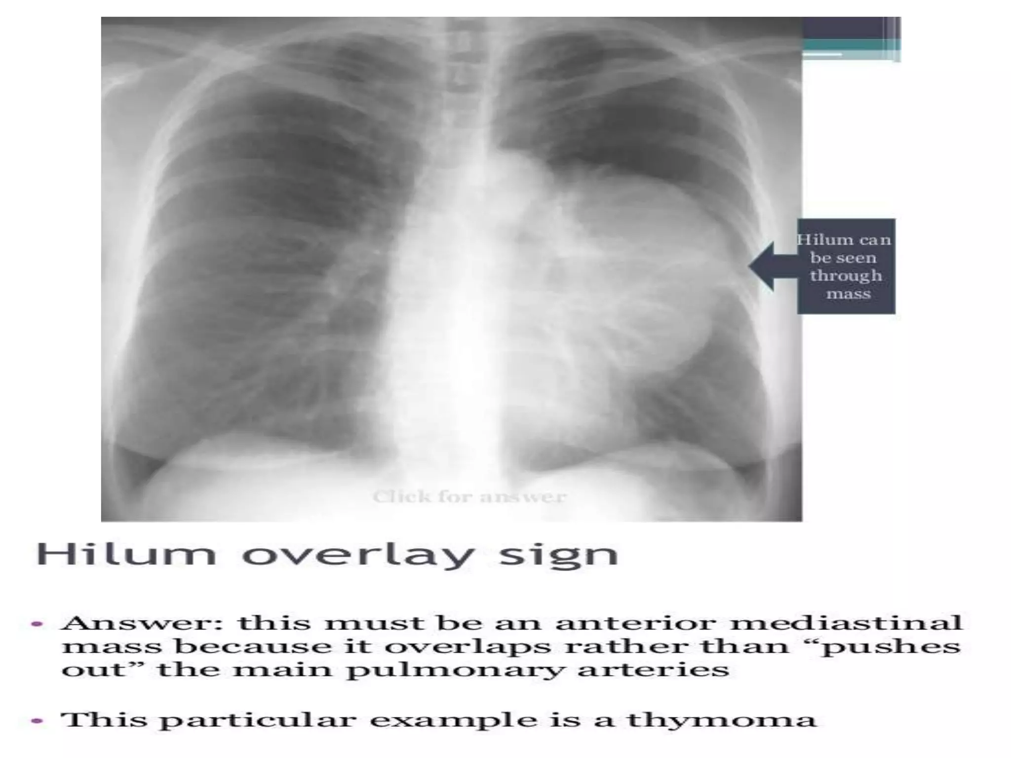 Mediastinal anatomy ,classification of mediastinal masses ans its ...