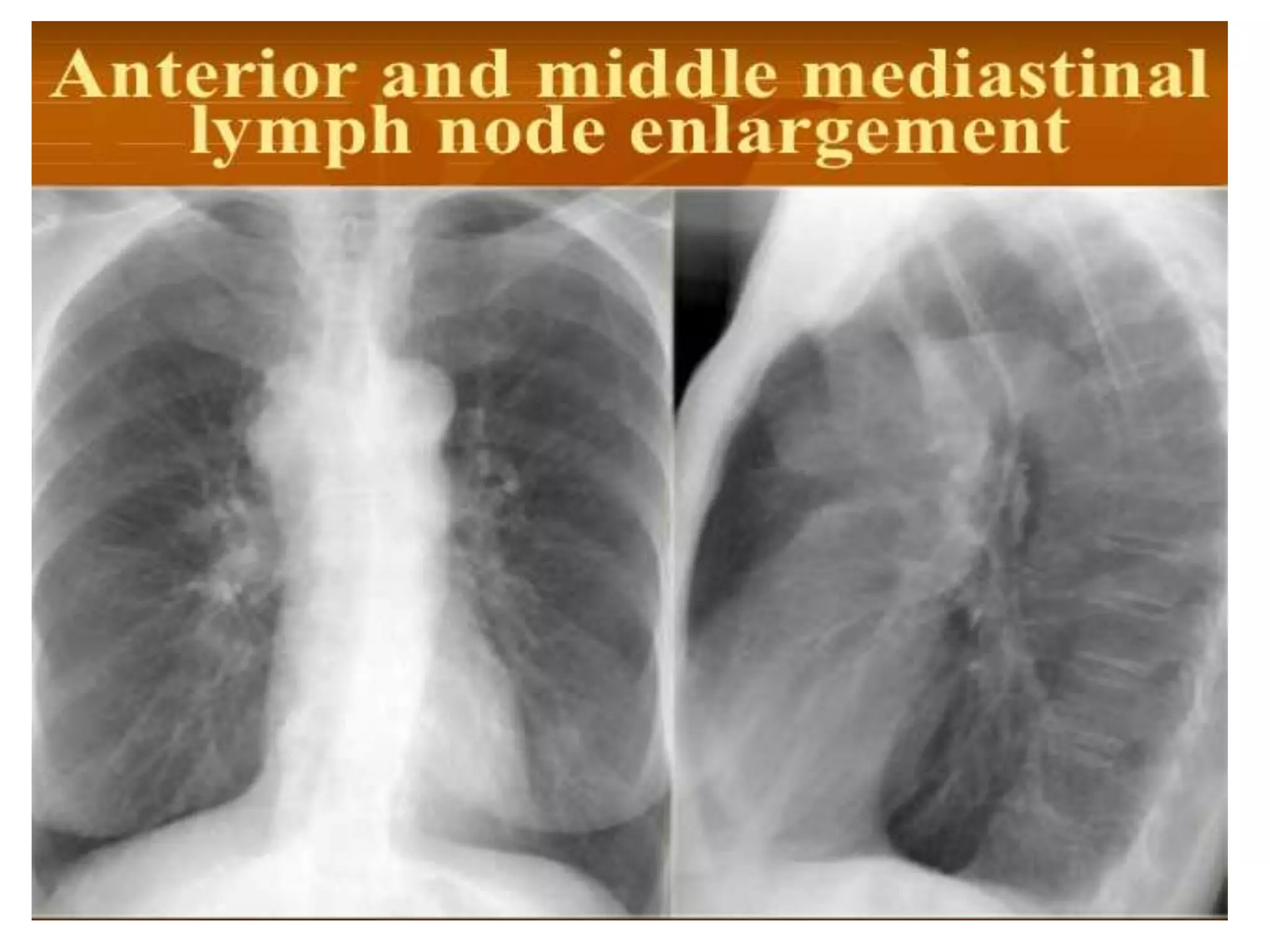 Mediastinal anatomy ,classification of mediastinal masses ans its ...