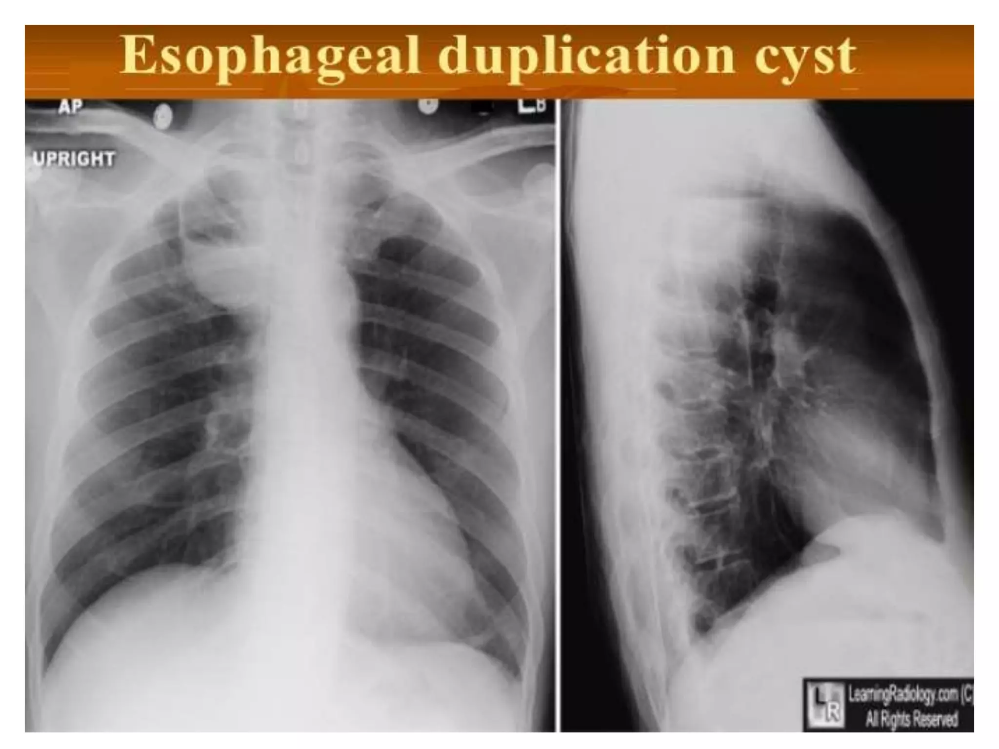 Mediastinal anatomy ,classification of mediastinal masses ans its ...