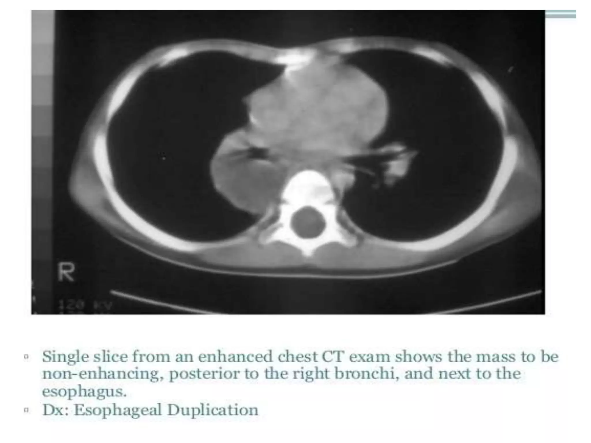 Mediastinal anatomy ,classification of mediastinal masses ans its ...