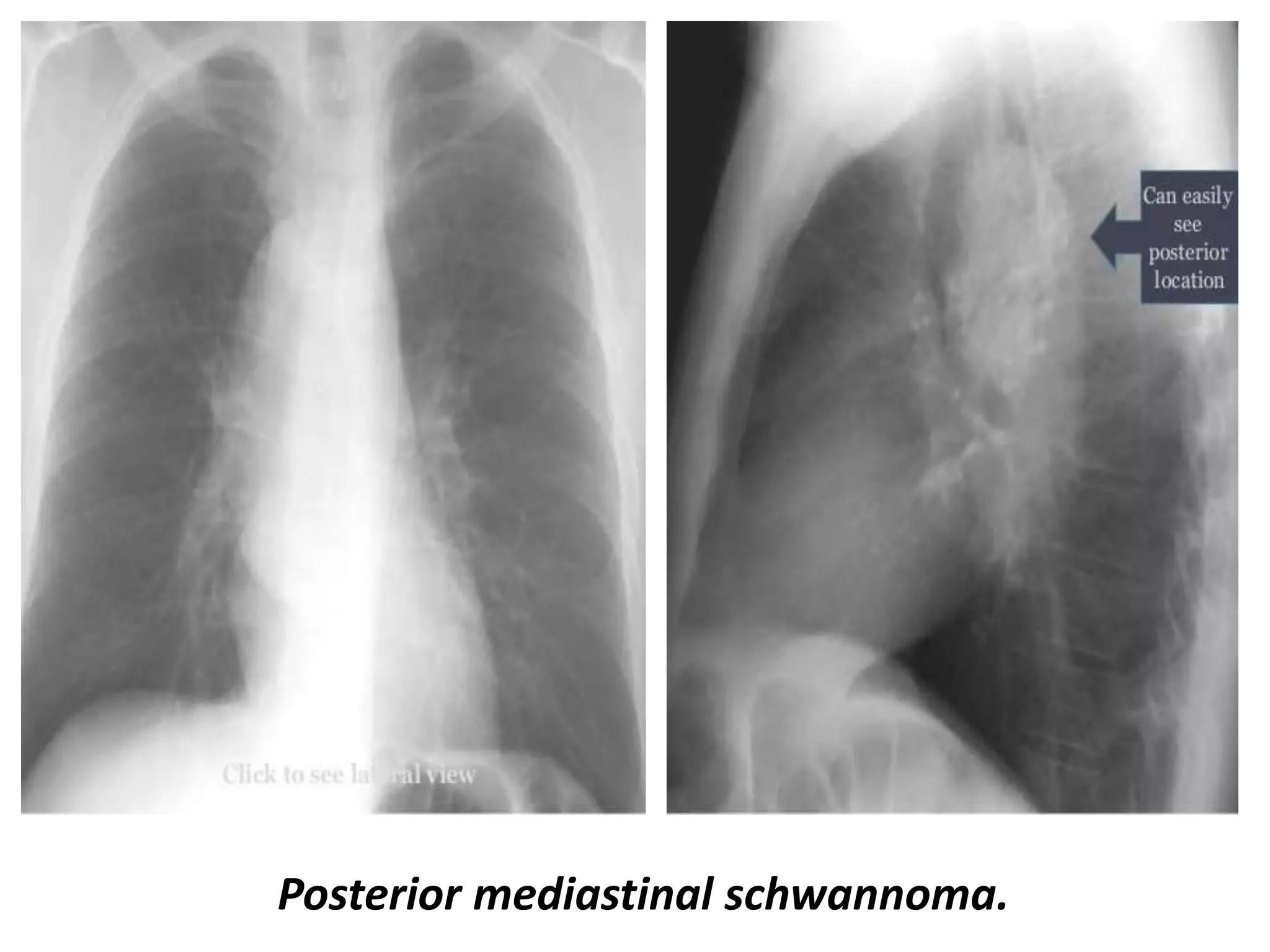 Mediastinal anatomy ,classification of mediastinal masses ans its ...