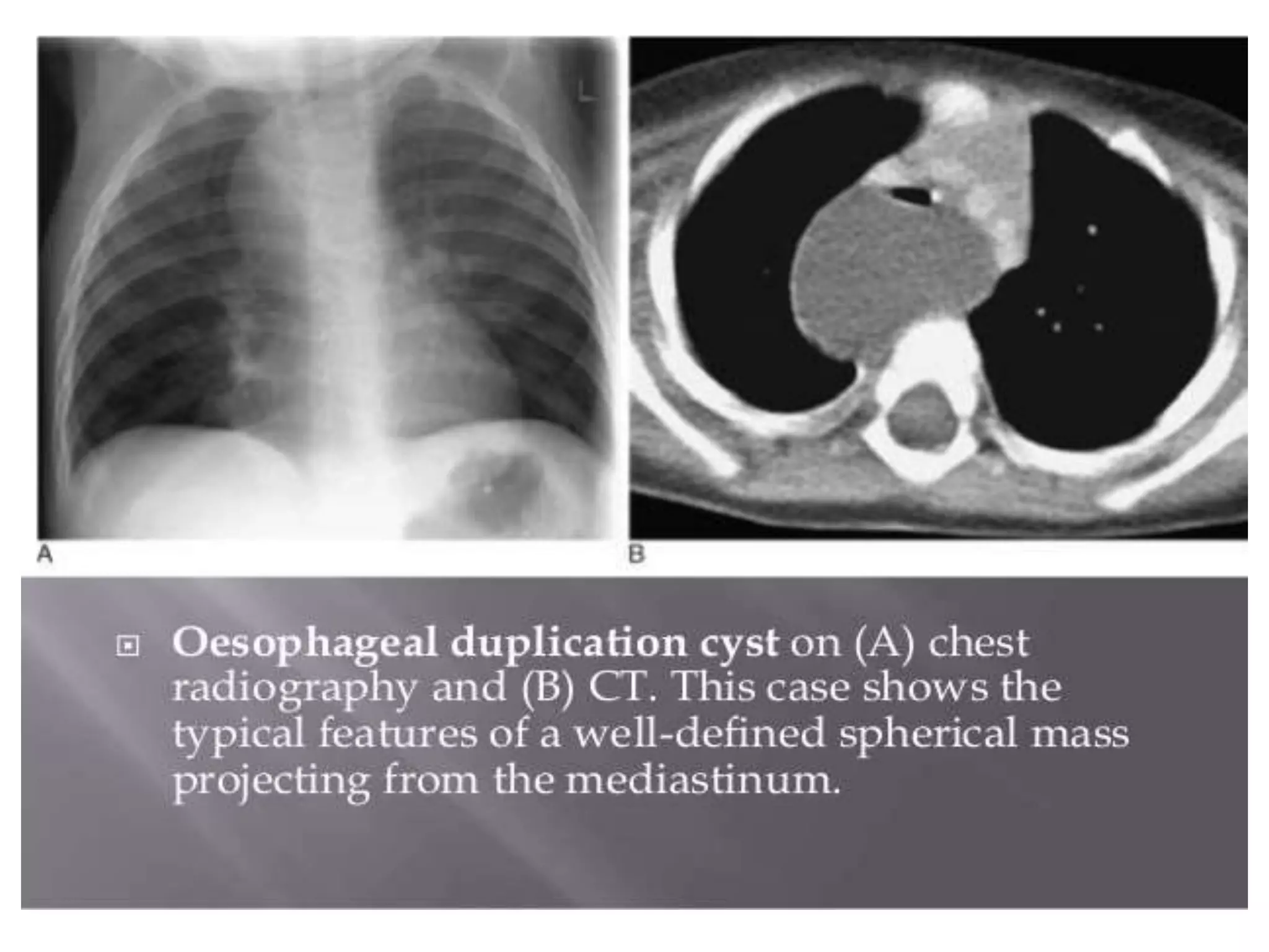 Mediastinal anatomy ,classification of mediastinal masses ans its ...