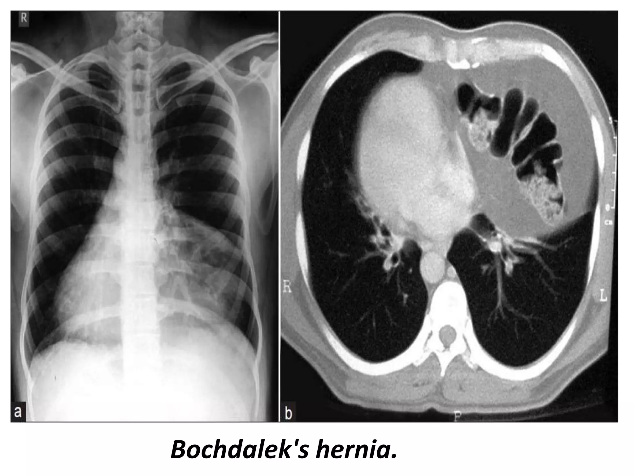 Mediastinal anatomy ,classification of mediastinal masses ans its ...