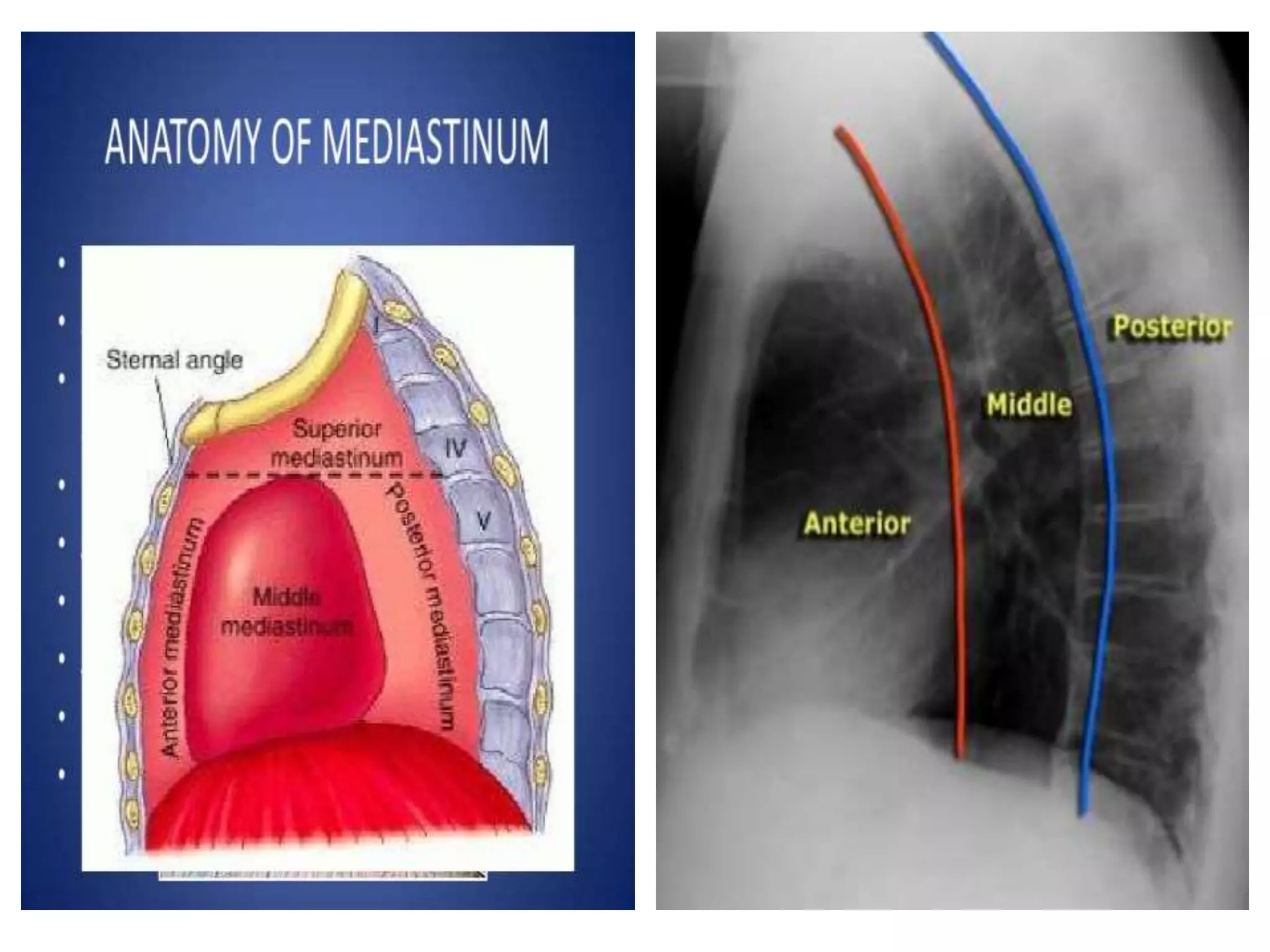 Mediastinal anatomy ,classification of mediastinal masses ans its ...