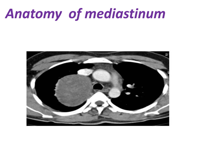 Mediastinal anatomy ,classification of mediastinal masses ans its ...