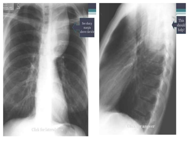 Mediastinal anatomy ,classification of mediastinal masses ans its ...
