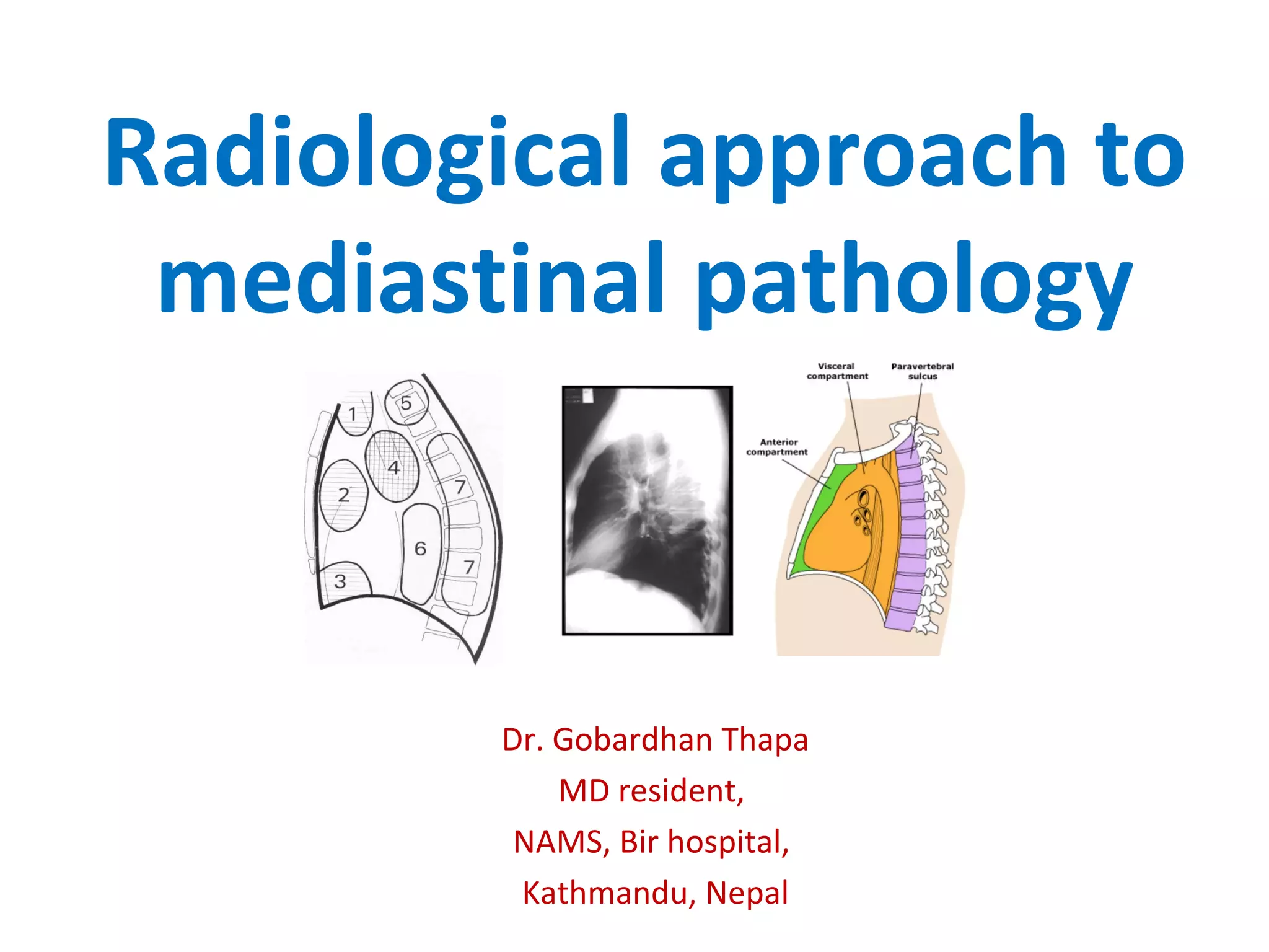 Mediastinal lesions final | PPT
