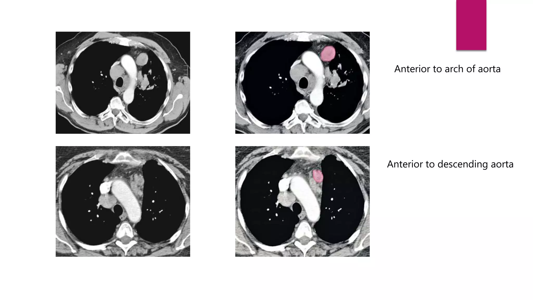 Mediastinal Lymph Nodes Pptx 1965