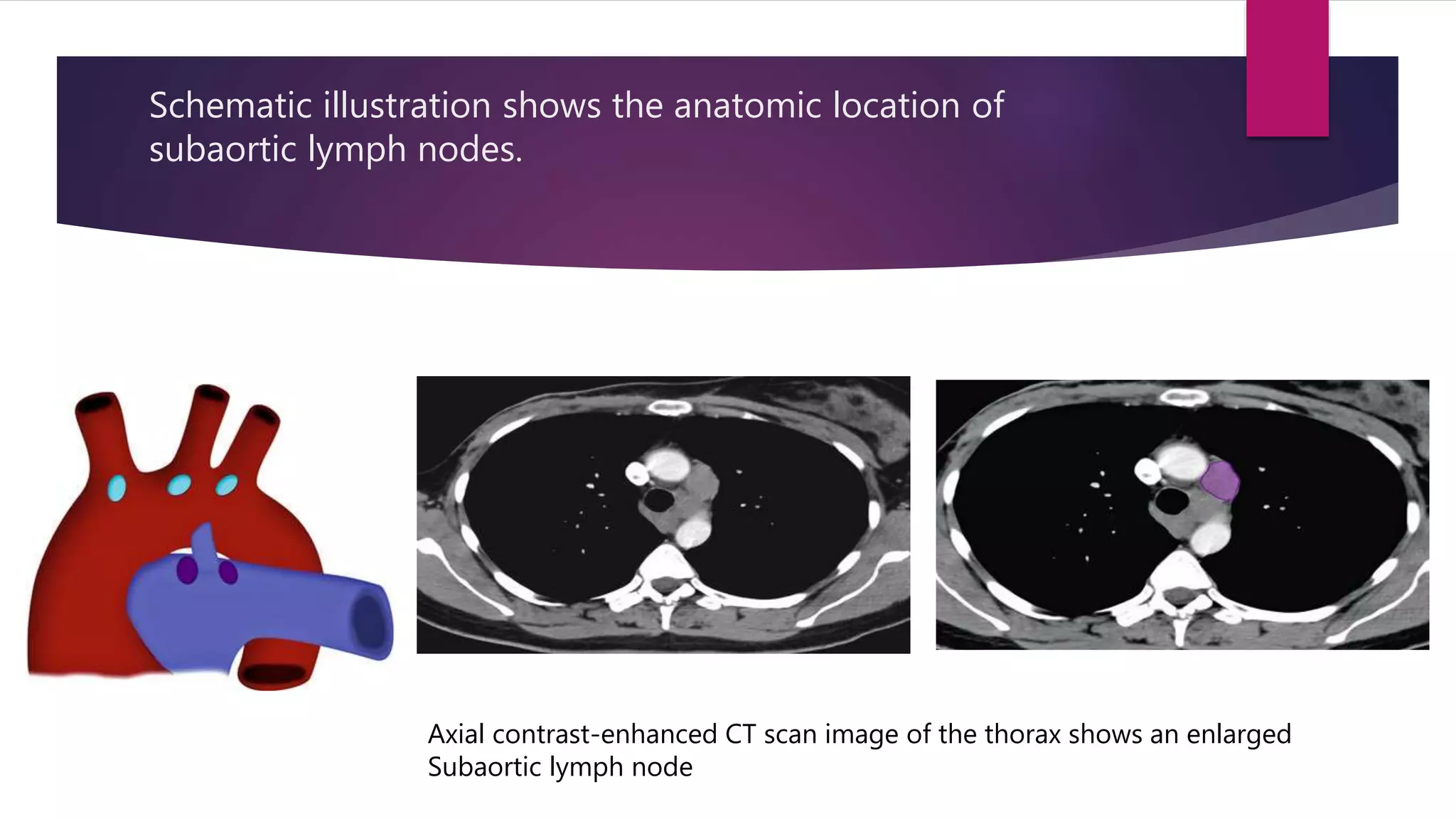 Mediastinal lymph nodes | PPTX