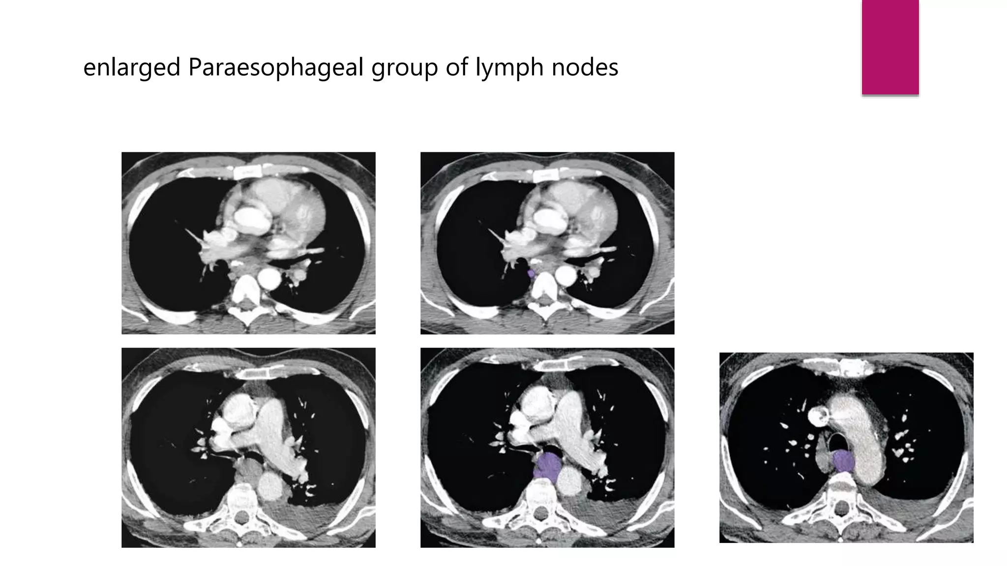 Mediastinal Lymph Nodes Pptx 5539