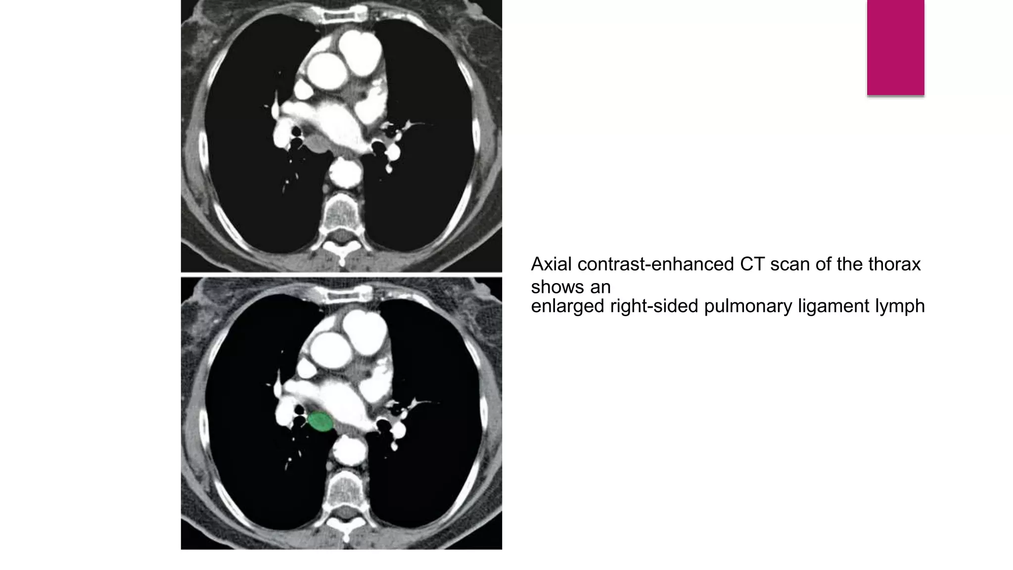 Mediastinal lymph nodes | PPTX