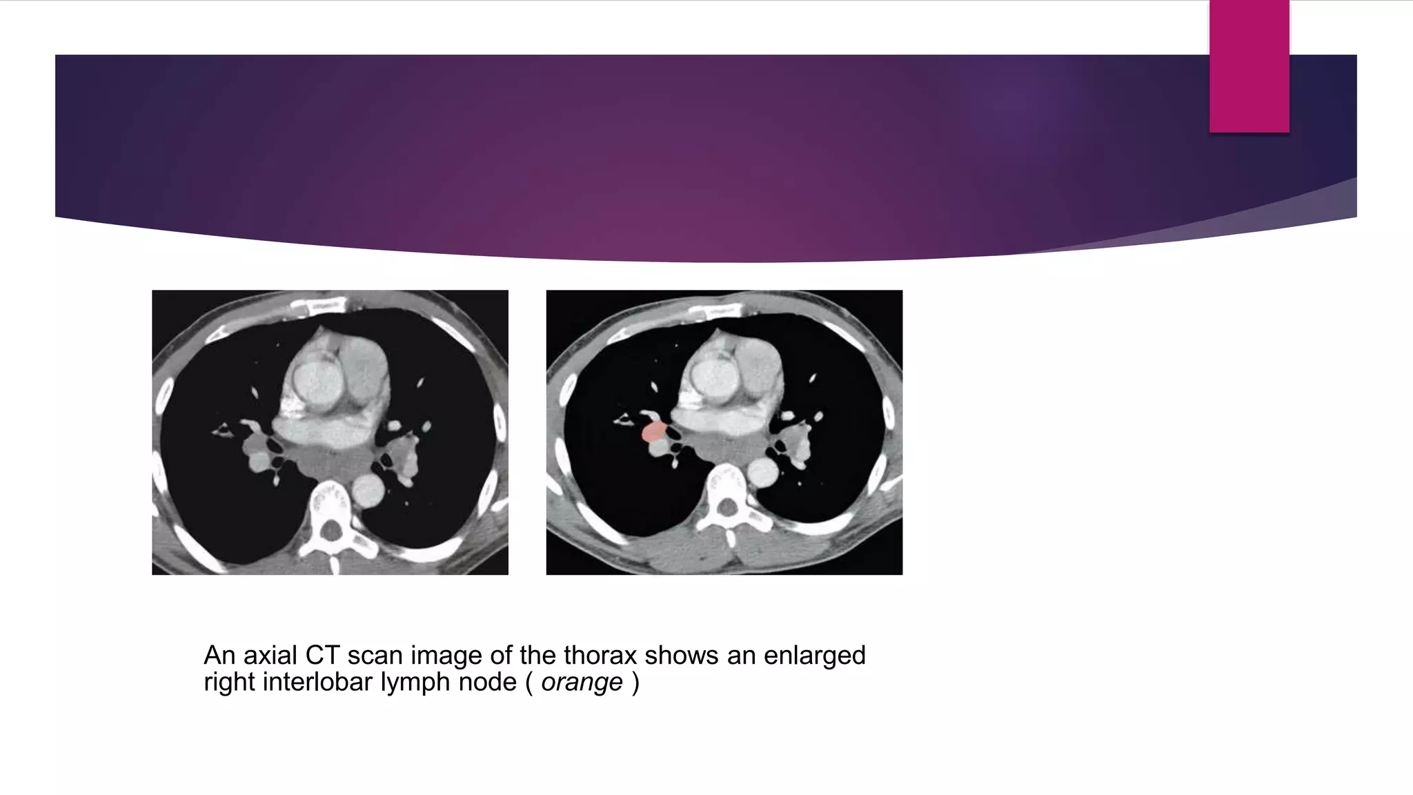 Mediastinal lymph nodes | PPTX