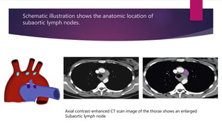 Mediastinal lymph nodes | PPTX
