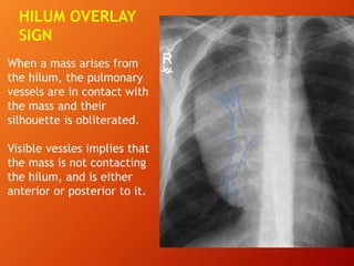 Mediastinal mass | PPT