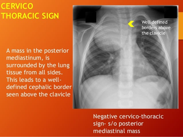 Mediastinal Mass