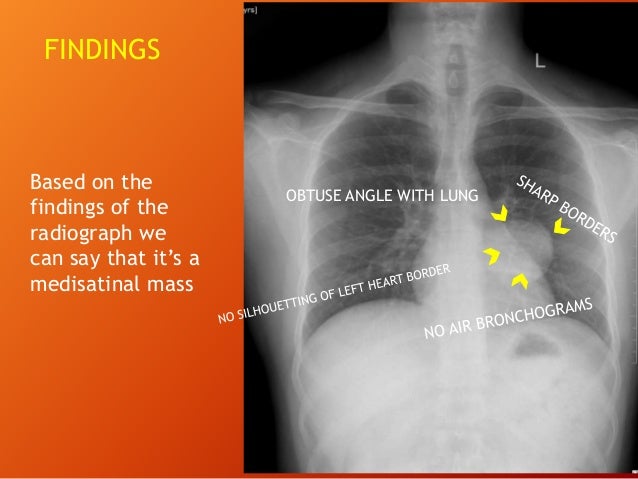 Mediastinal mass