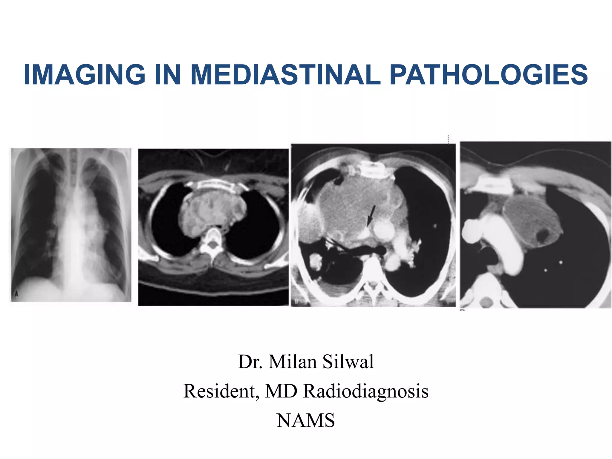 Imaging in mediastinal masses by Dr. Milan Silwal | PPT
