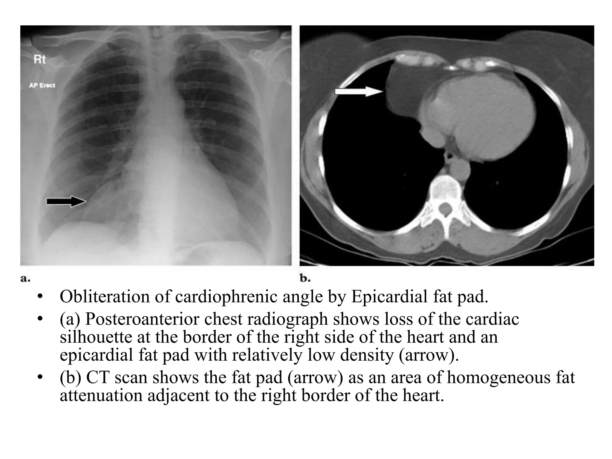 Imaging in mediastinal masses by Dr. Milan Silwal | PPT