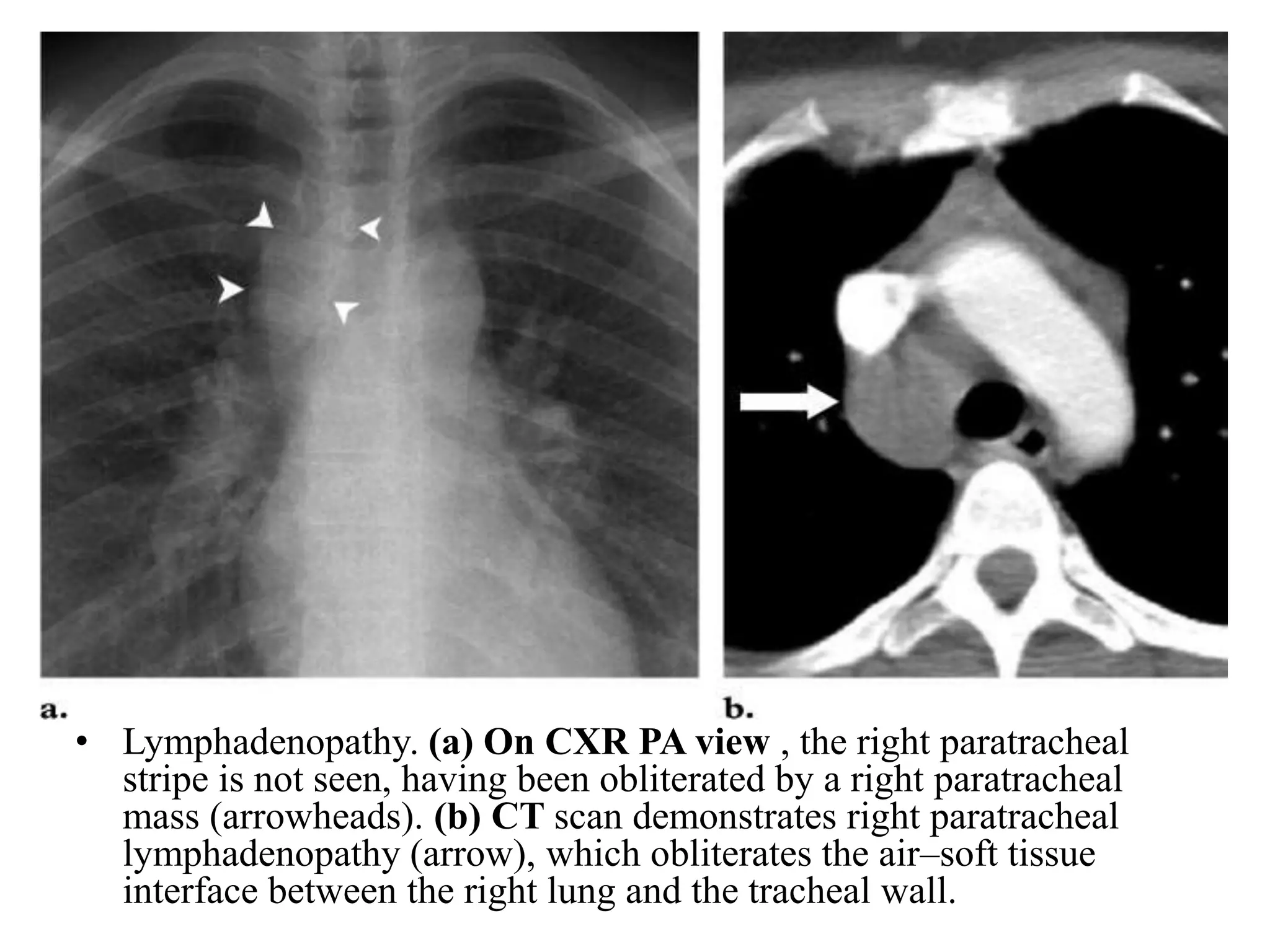 Imaging in mediastinal masses by Dr. Milan Silwal | PPT