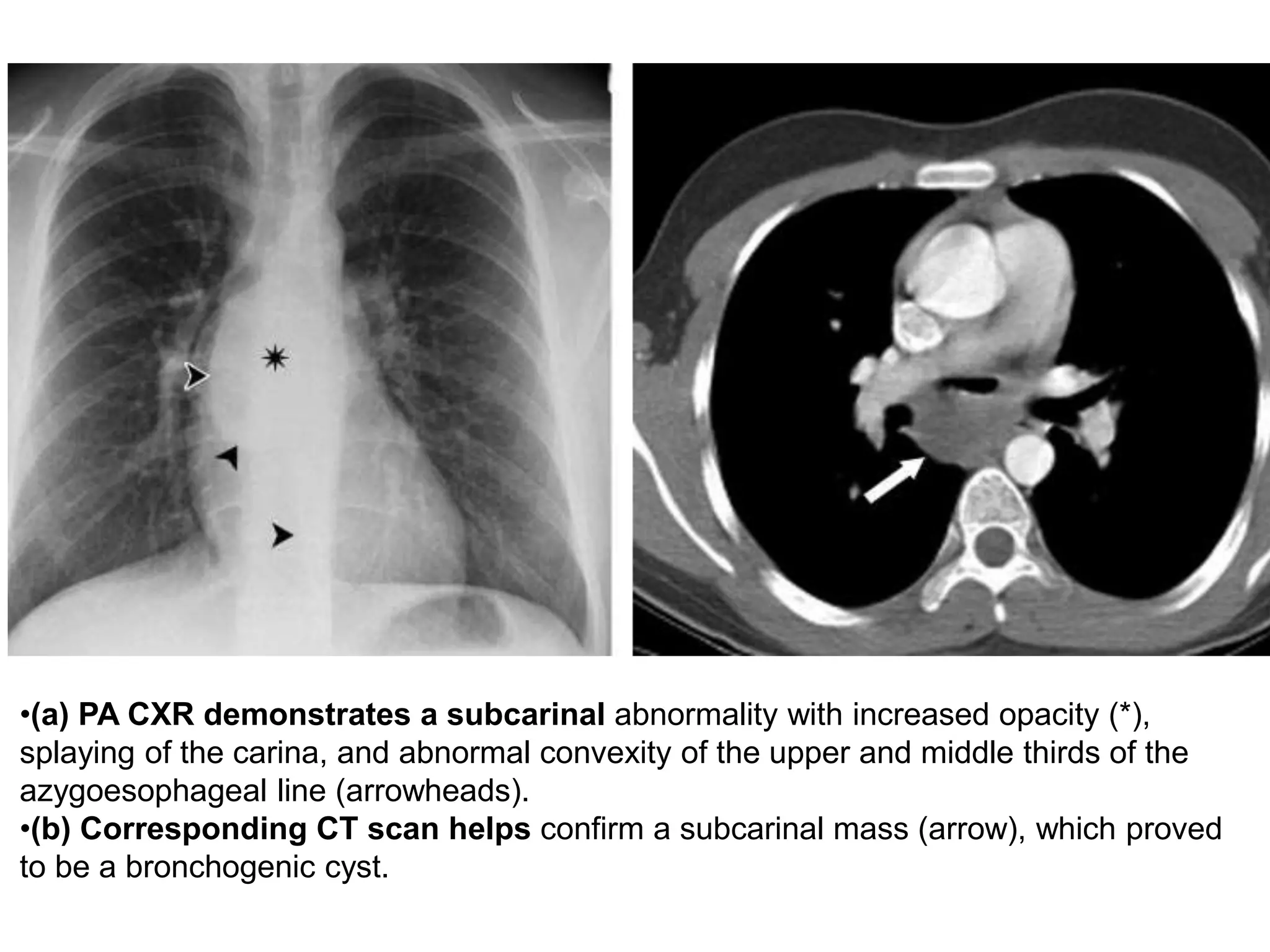 Imaging in mediastinal masses by Dr. Milan Silwal | PPT