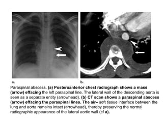 Imaging in mediastinal masses by Dr. Milan Silwal | PPT