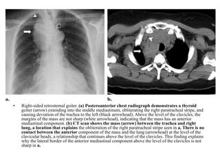 Imaging in mediastinal masses by Dr. Milan Silwal | PPT