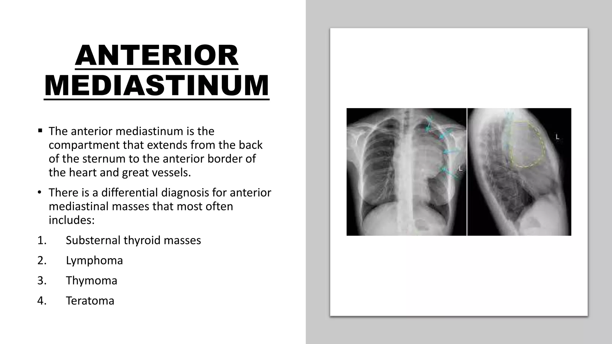 Radiological study on Mediastinal masses | PPTX