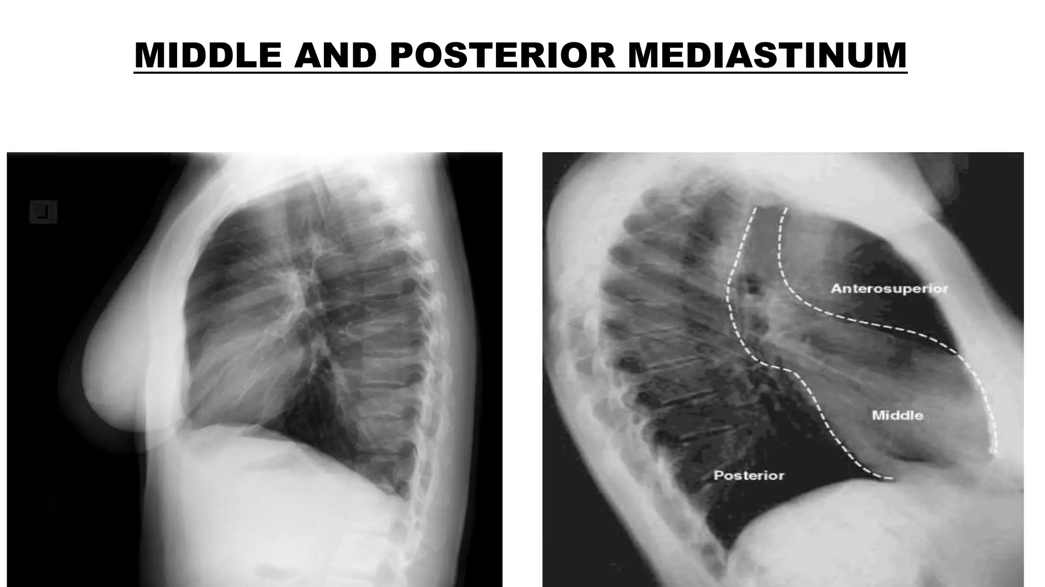 Radiological study on Mediastinal masses | PPTX